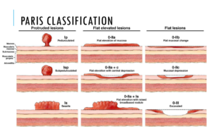 The Paris endoscopic classification of lesions in the esophagus ...